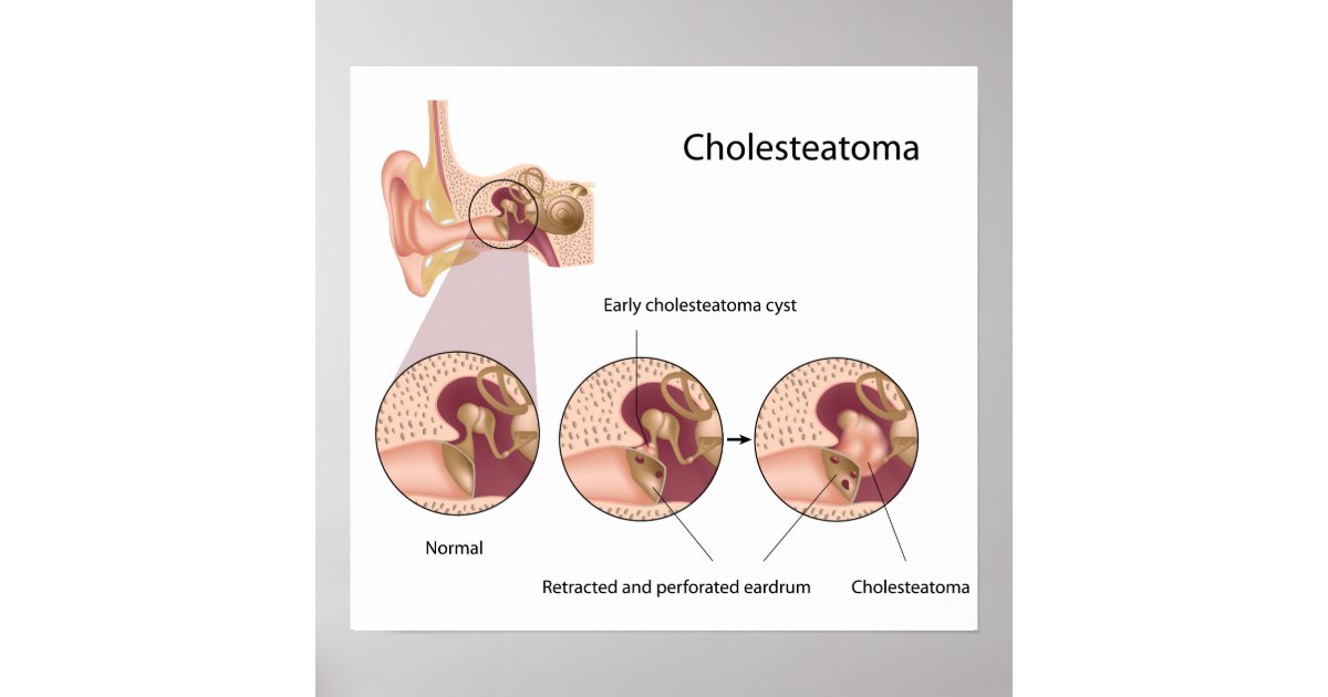 Cholesteatoma middle ear tumour Poster | Zazzle