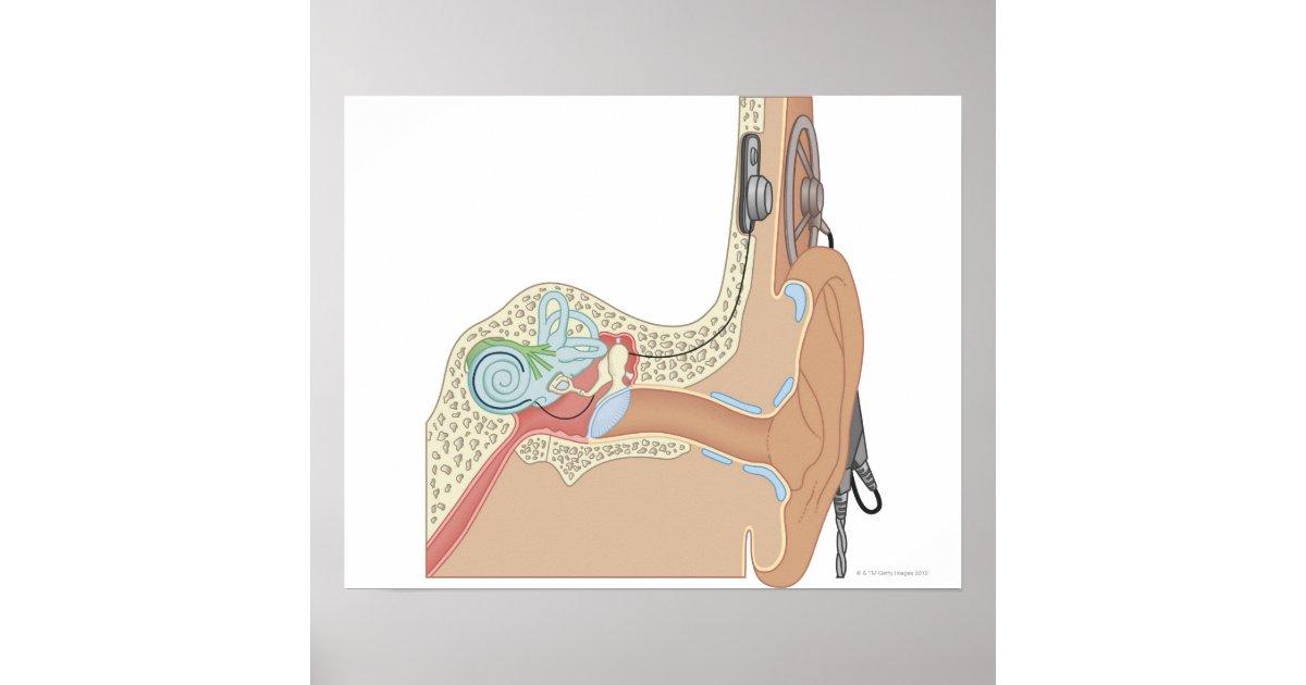 Cochlear Implants Poster | Zazzle