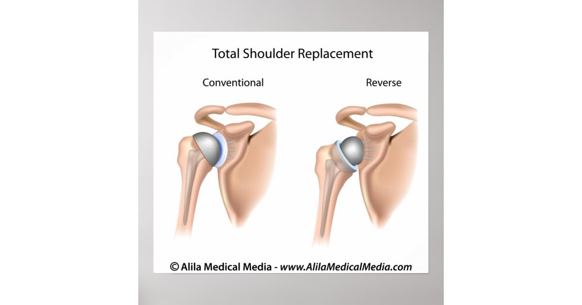 Conventional vs reverse total shoulder replacement poster | Zazzle