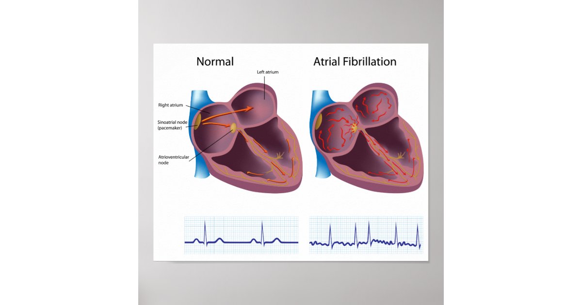 Heart disease atrial fibrillation Poster | Zazzle