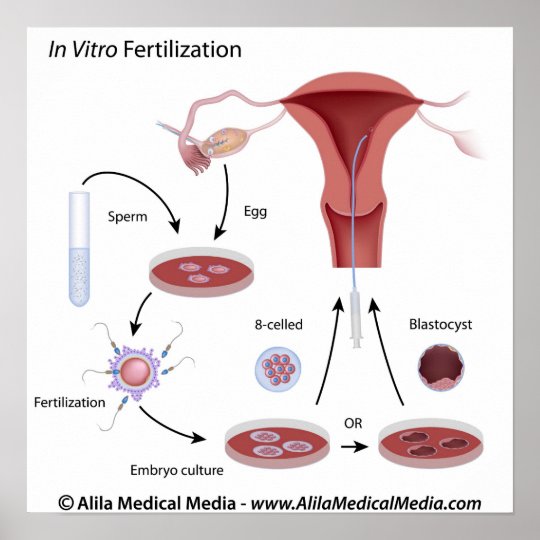 In Vitro Fertilisation (IVF) procedure labelled. Poster | Zazzle.co.uk