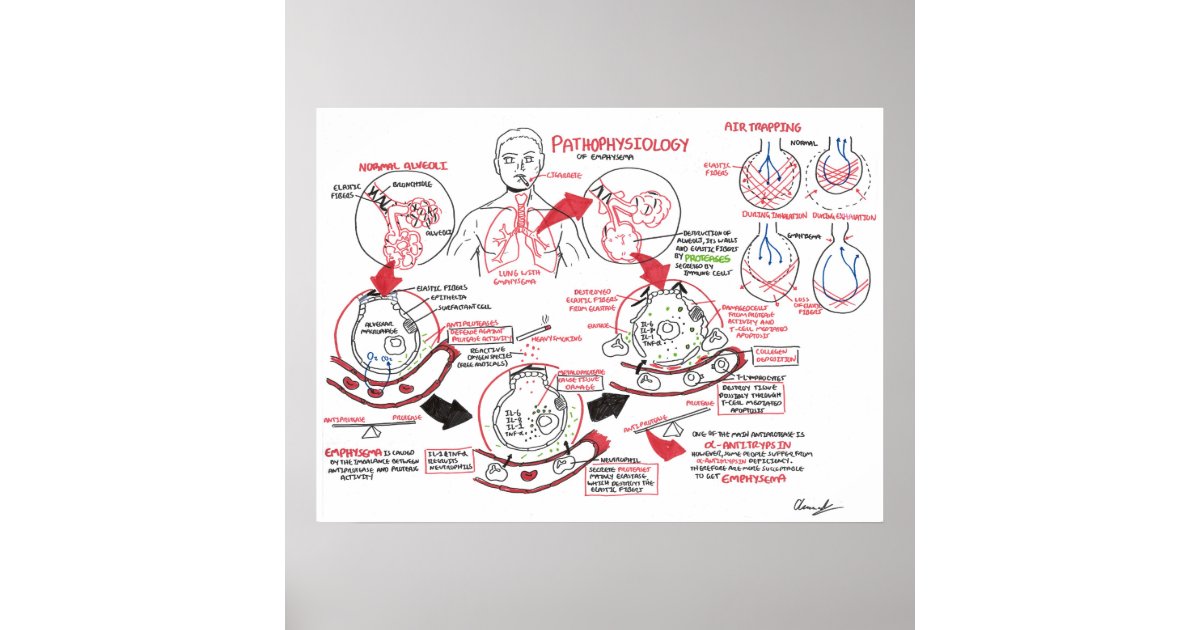 Pathophysiology of Emphysema Poster | Zazzle