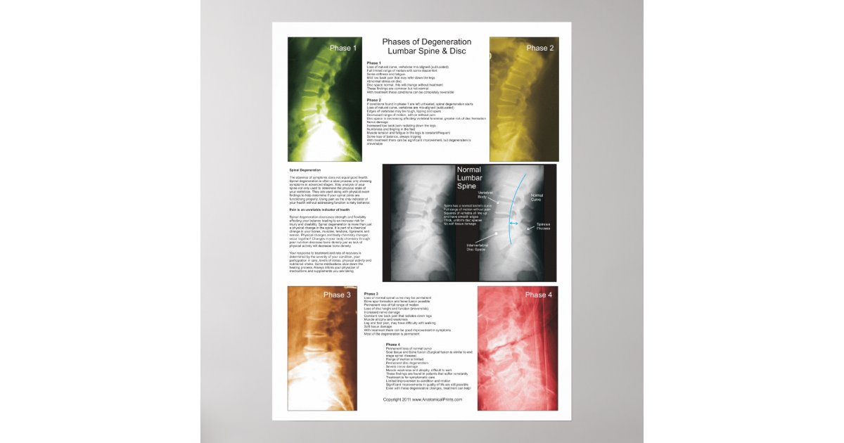 Phases Lumbar Spinal Degeneration Poster | Zazzle