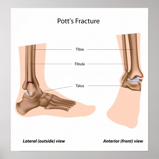 Pott's fracture Poster | Zazzle.co.uk