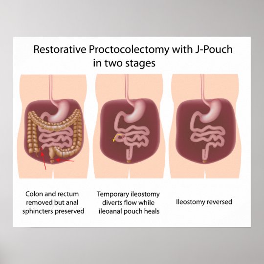 Restorative proctocolectomy with j-pouch 2 stages poster | Zazzle.co.uk