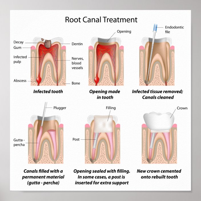 Root canal treatment Poster | Zazzle.co.uk