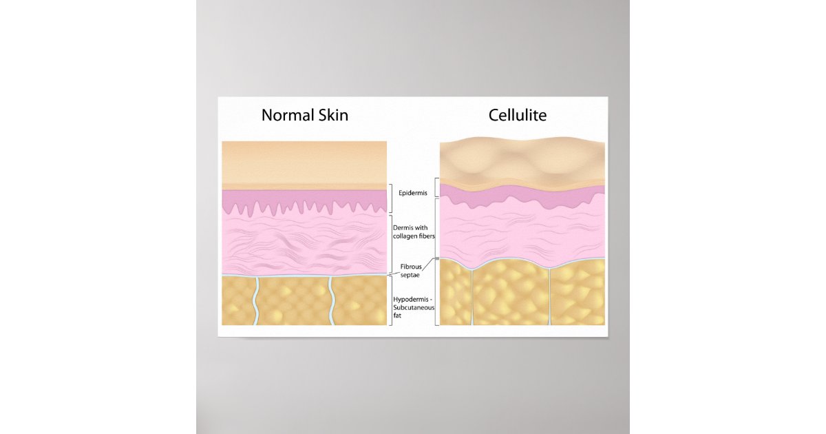 Skin cellulite Poster | Zazzle