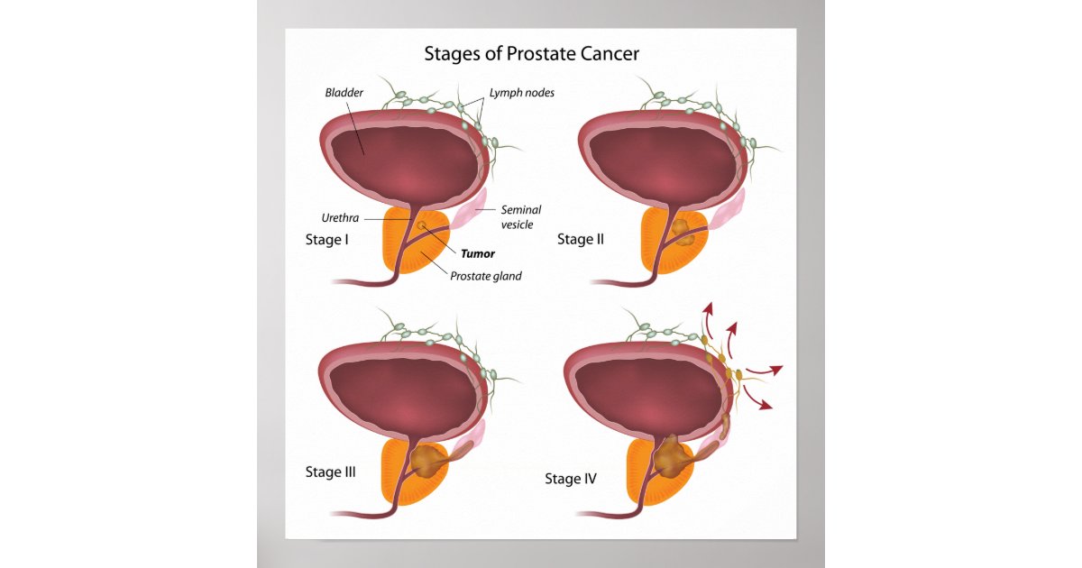 Stages of prostate cancer Poster | Zazzle.co.uk