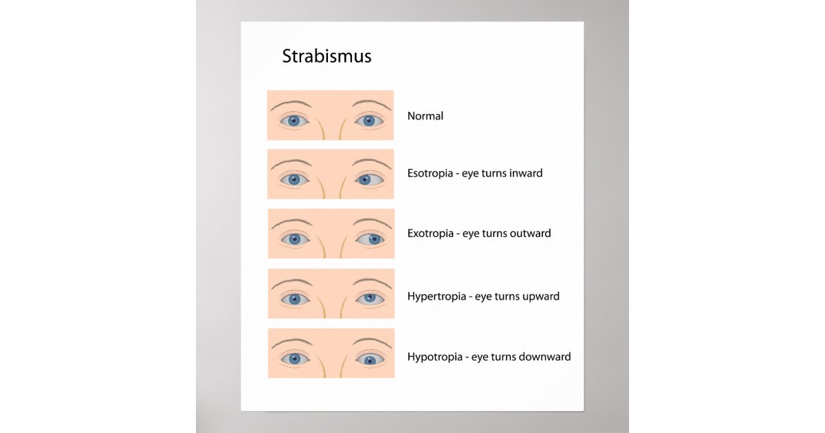 Strabismus eye defect Poster | Zazzle