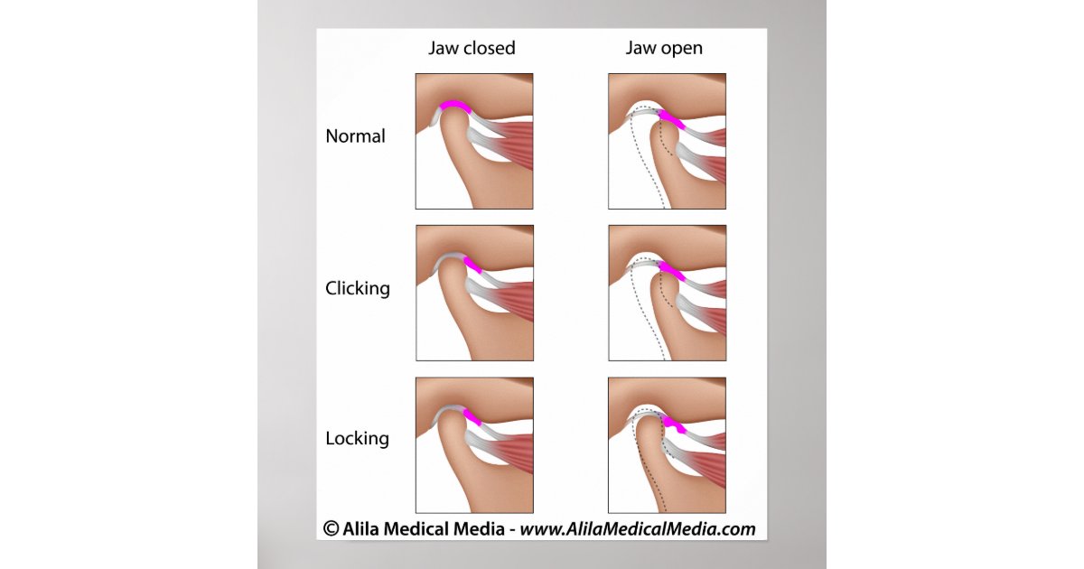 Temporomandibular joint dysfunction, TMJ or TMD Poster | Zazzle