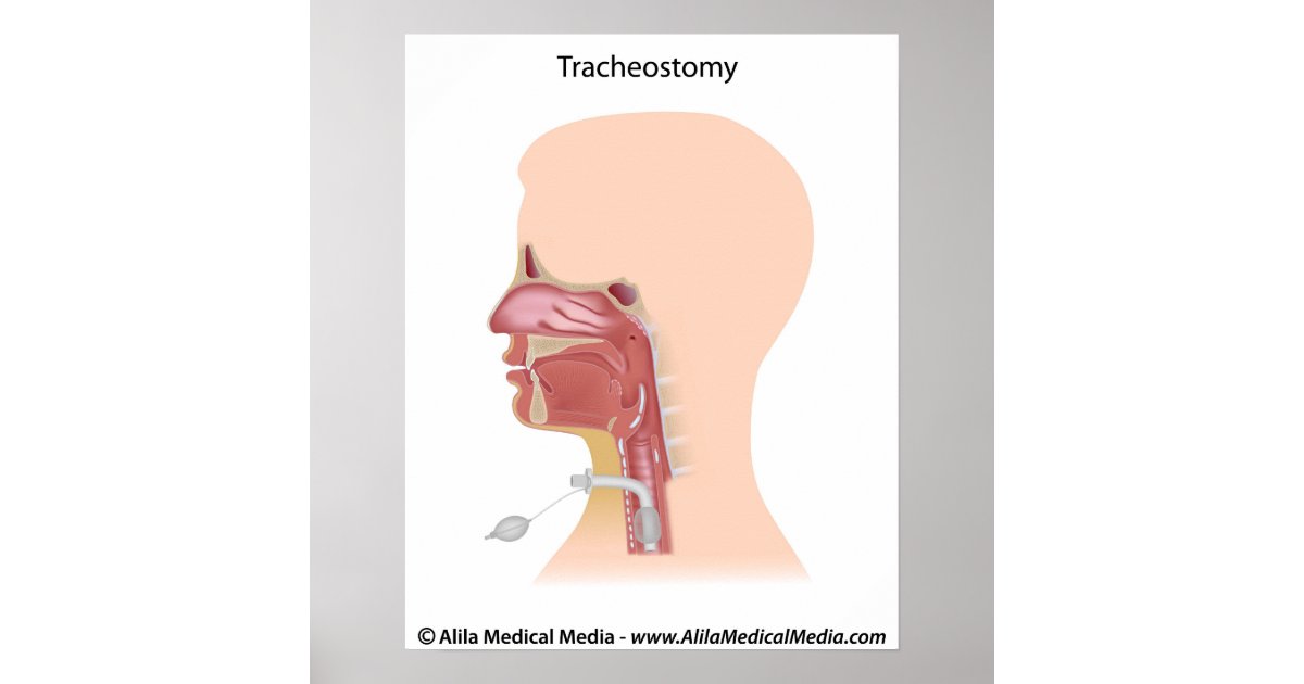 Tracheostomy drawing. poster | Zazzle